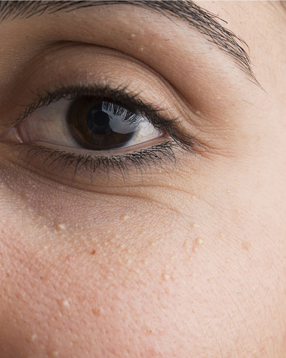 Milia - Skin Solution - Hamilton